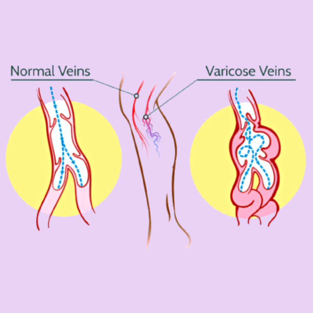 Diosmin - Capillary & Vein Support – Get Body Back LTD